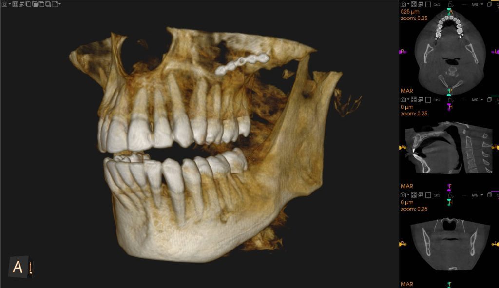 Computed Tomography (CBCT) - Skanai
